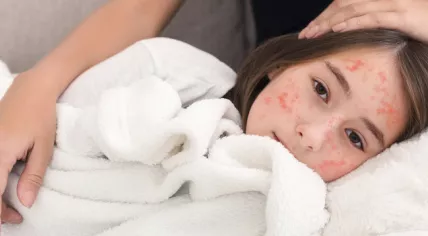 Dutch measles cases jump by 46% in a week as primary school clusters ...